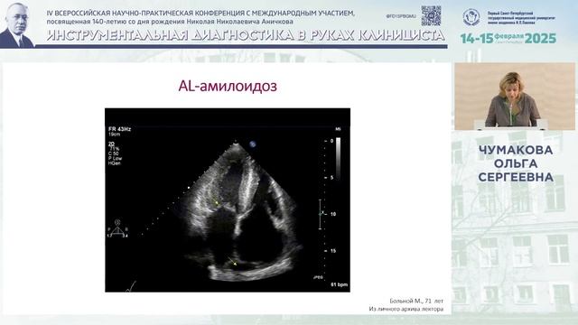 Амилоидная кардиопатия: когда следует заподозрить?