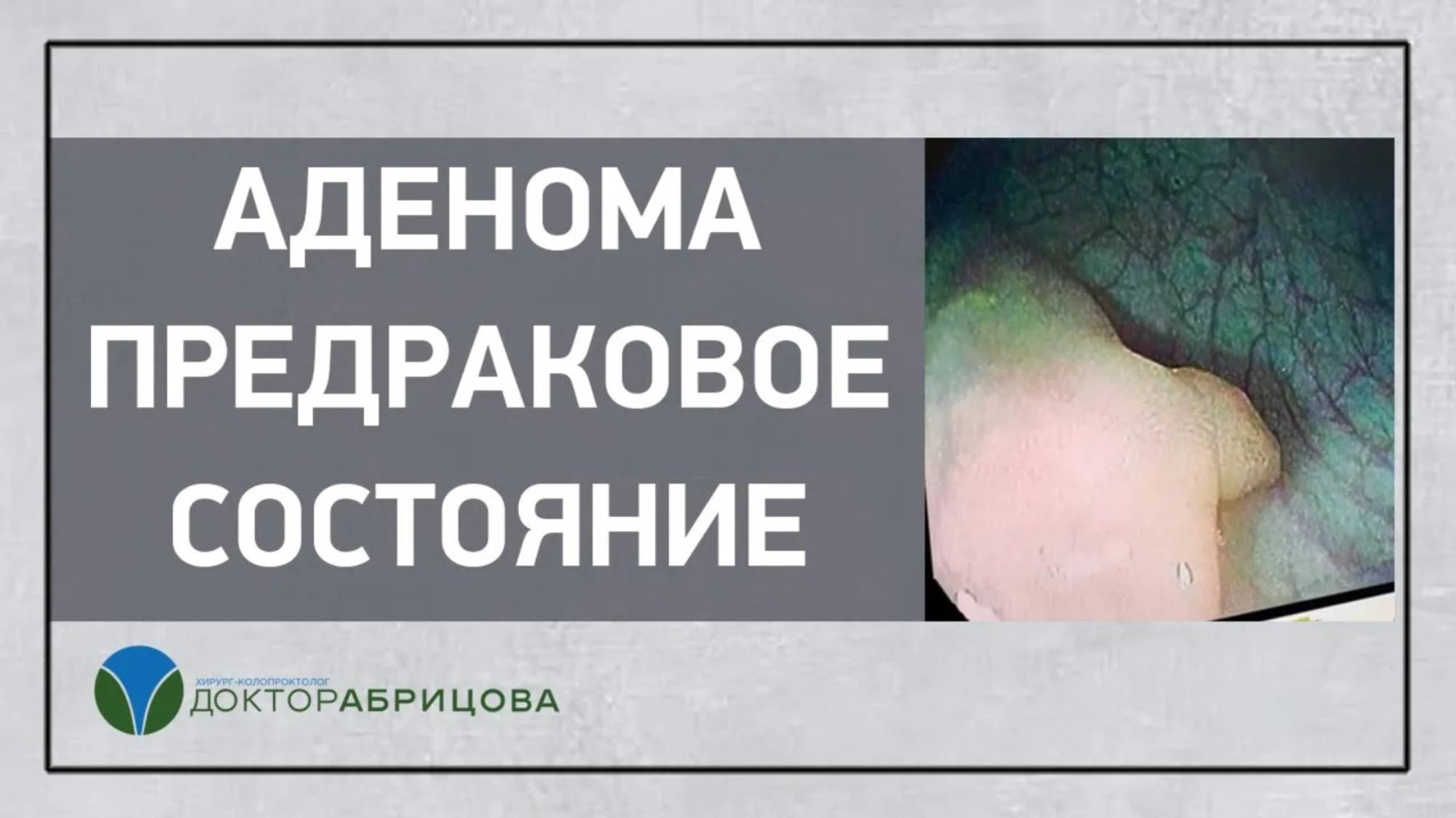 АДЕНОМА в сигмовидной кишке. Предрак без симптомов и жалоб