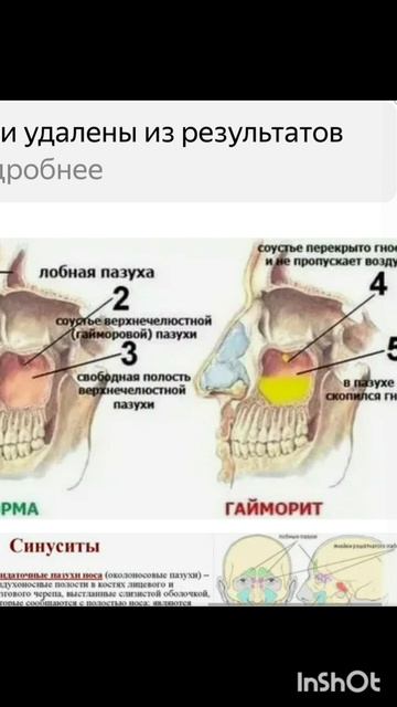 ПроЗдоровье.Операция на верхнечельстной пазухе.Фильм2.Серия5 .mp4