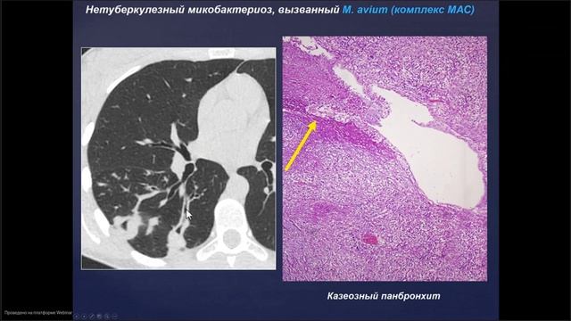 ЛЕГОЧНЫЕ МИКОБАКТЕРИОЗЫ   Ирина Соколина