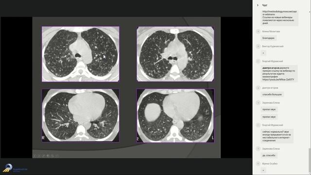 Редкие интерстициальные заболевания легких   Ирина Соколина