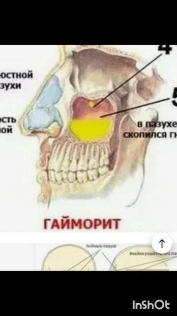 ПроЗдоровье.Операция на верхнечельстной пазухе.Фильм1.Серия2.Часть6 .mp4