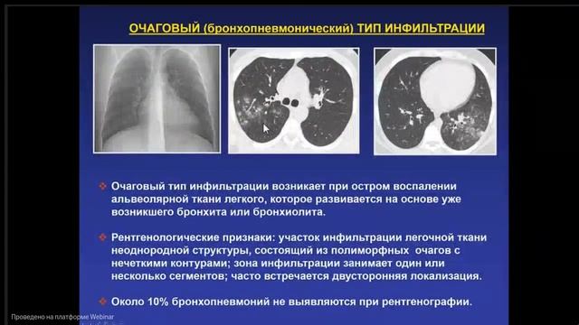 КТ ДИАГНОСТИКА ПНЕВМОНИЙ  Ирина Соколина