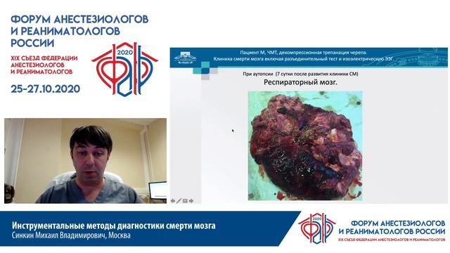 Инстррументальные методы дагноза смерти мозга Синкин МВ  ФАРР 2020