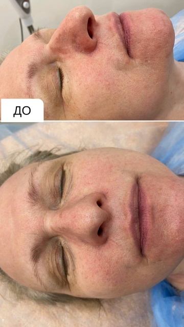 Методы коррекции пигментации