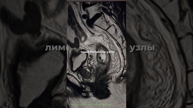 МРТ малого таза мужчины 64 лет с опухолью средне нижнеампулярного отдела прямой кишки.