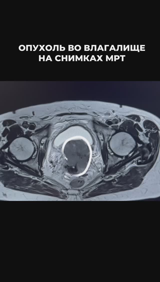 Опухоль влагалища на снимках МРТ