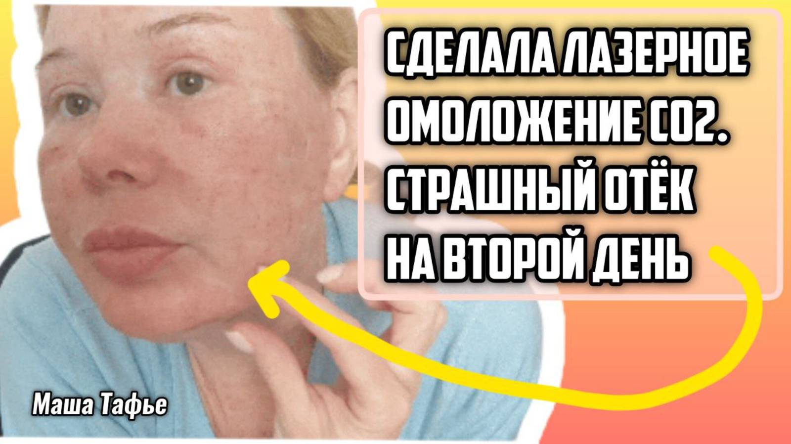 Сделала лазерное омоложение СО2. Страшный отёк на второй день. Весна с Машей 🌷 Видео №48