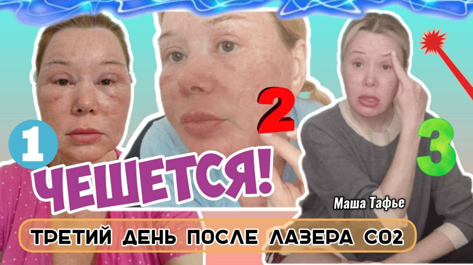 Чешется! Третий день после лазера СО2. Весна с Машей 🌷 Видео №49
