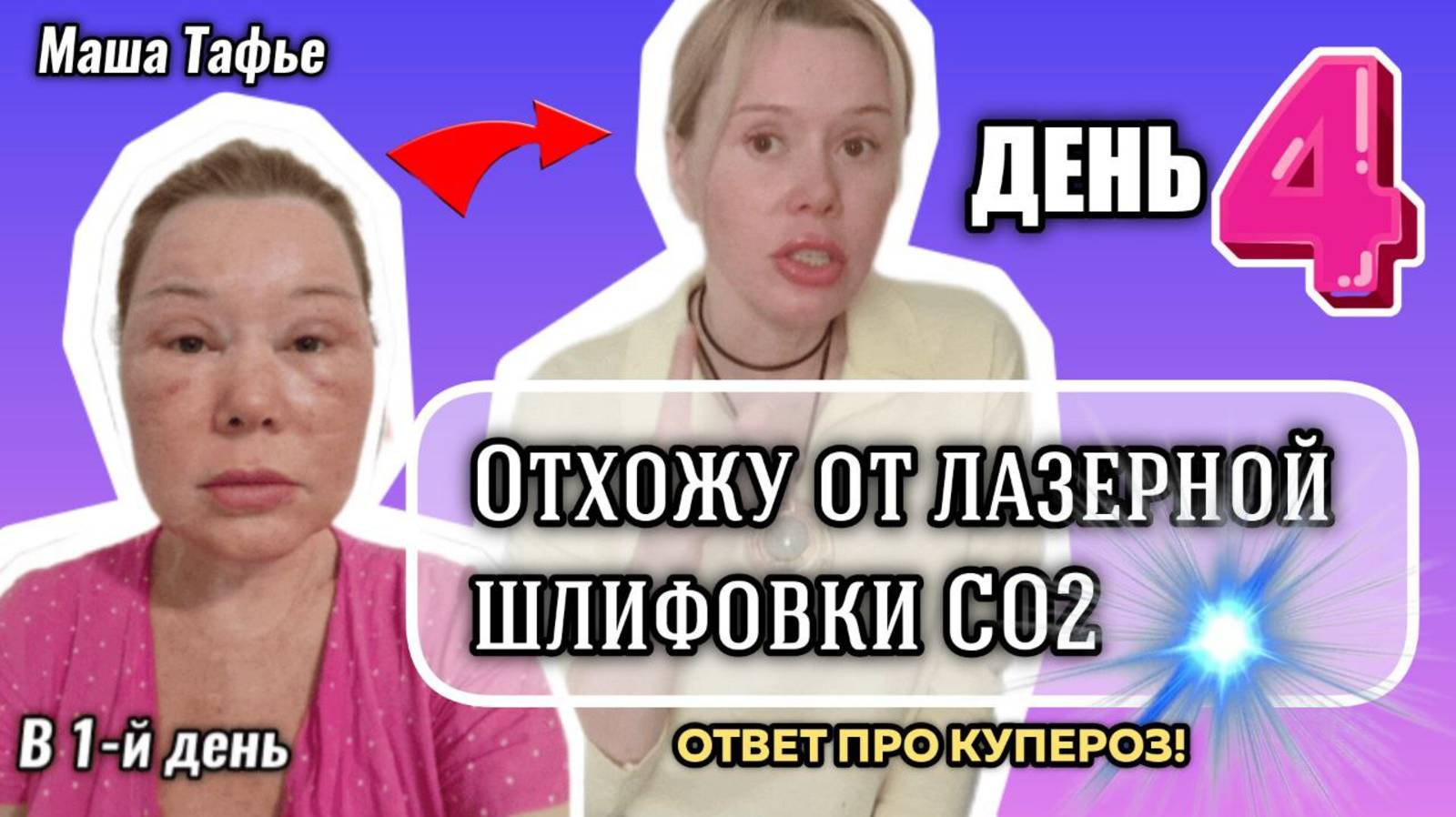Отхожу от лазерной шлифовки СО2. День 4. Ответ про борьбу с куперозом. Весна с Машей 🌷 Видео №50