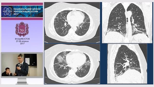 Идиопатические интерстициальные пневмонии И.Е. Тюрин  2017
