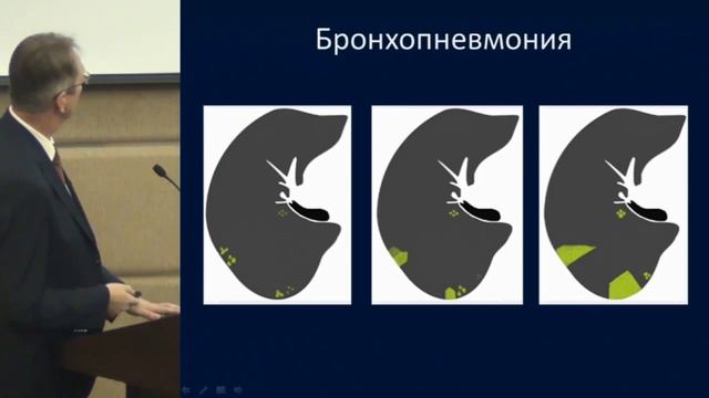 Трудности рентгенологической диагностики пневмонии Тюрин И Е 2015