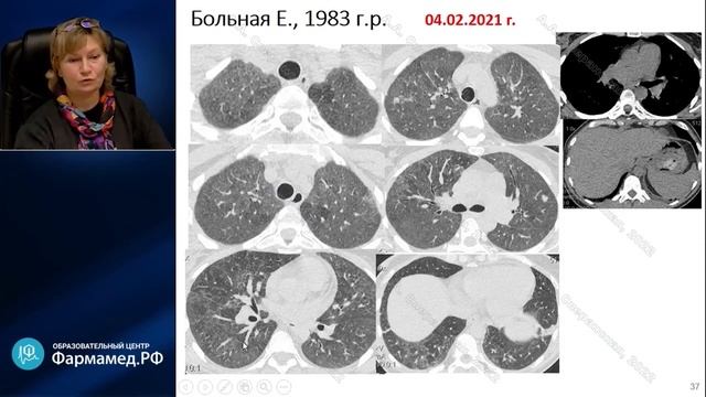 Дифференциальная диагн-ка интерстициальных поражений легких при COVID-19 Сперанская А.А.