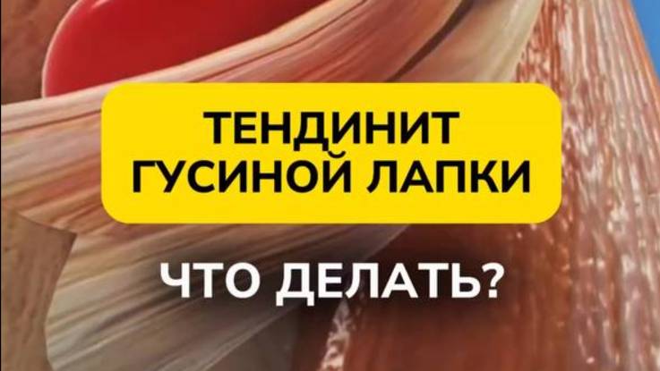 ТЕНДИНИТ ГУСИНОЙ ЛАПКИ: ЧТО ДЕЛАТЬ?