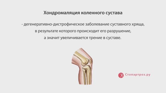 Хондромаляция коленного сустава, причины и лечение