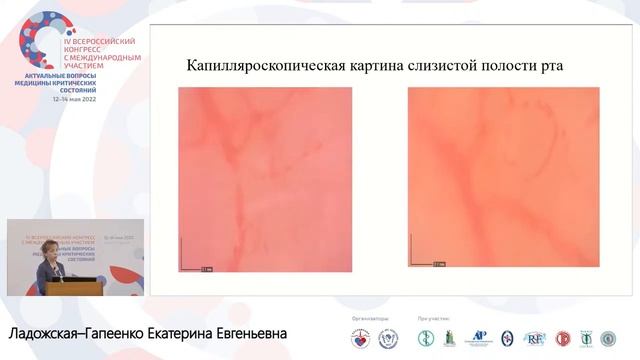 Микроциркуляция при Covid 19  Ладожская Гапеенко Е.Е.  АиР СПб 2022