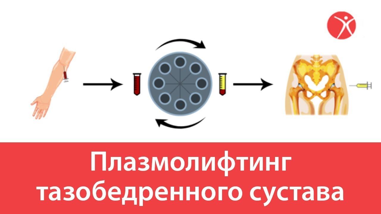 Плазмолифтинг тазобедренного сустава в клинике Стопартроз