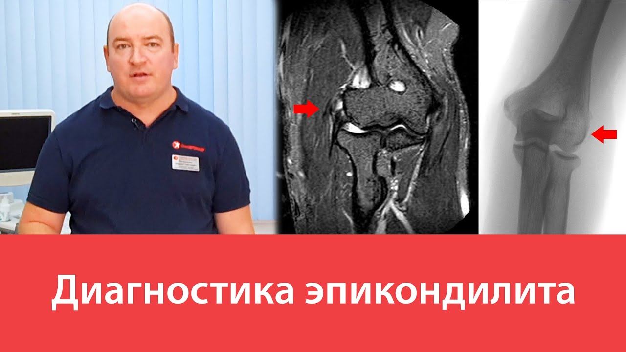 Диагностика эпикондилита