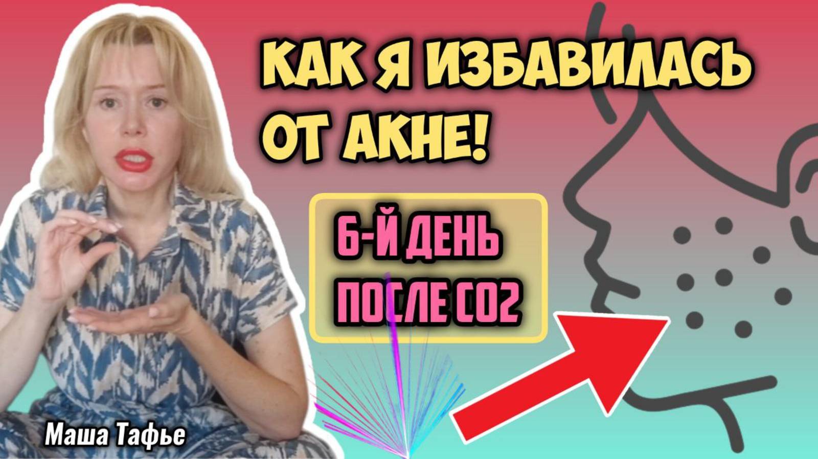 Как я избавилась от акне! 6-й день после СО2. Весна с Машей 🌷 Видео №52