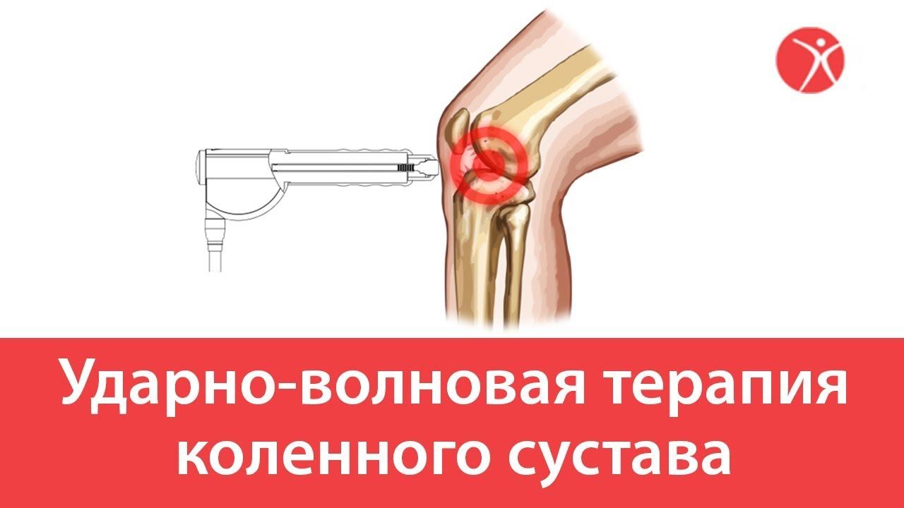 Ударно-волновая терапия коленного сустава в клинике Стопартроз