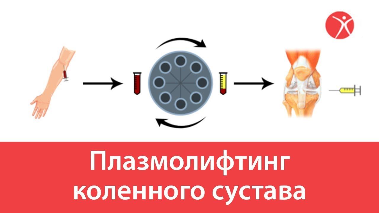 Плазмолифтинг коленного сустава в клинике Стопартроз