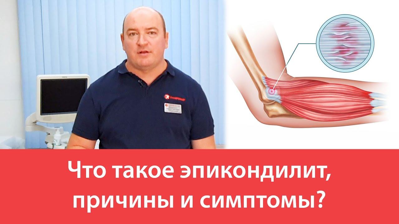 Что такое эпикондилит, причины и симптомы?