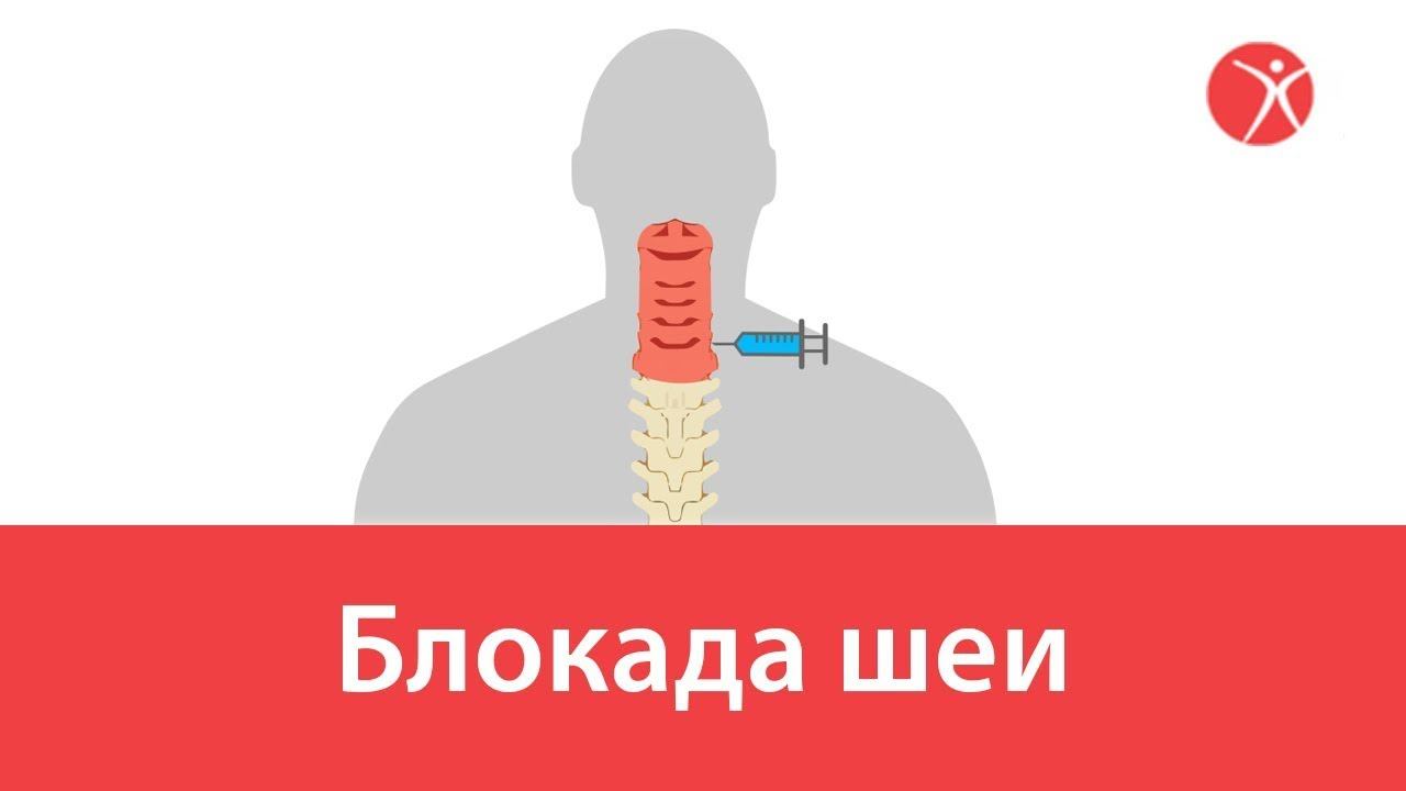 Блокада шеи в клинике Стопартроз
