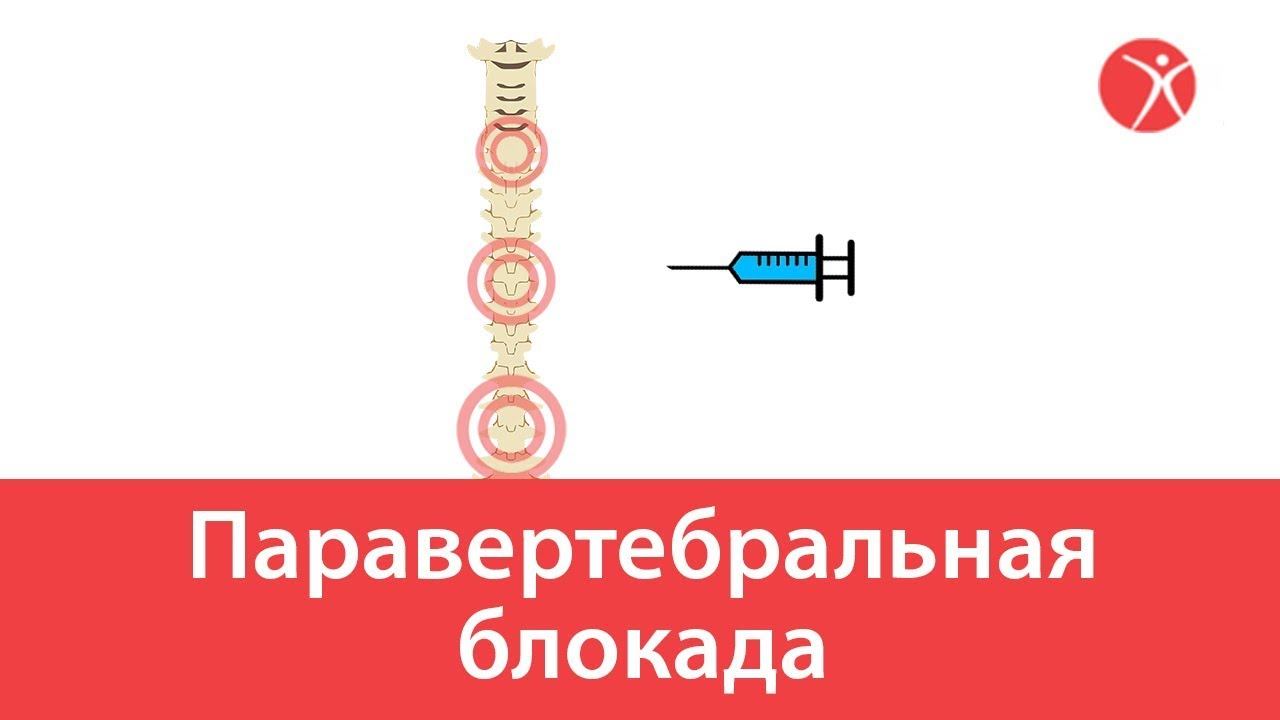 Паравертебральная блокада в клинике Стопартроз