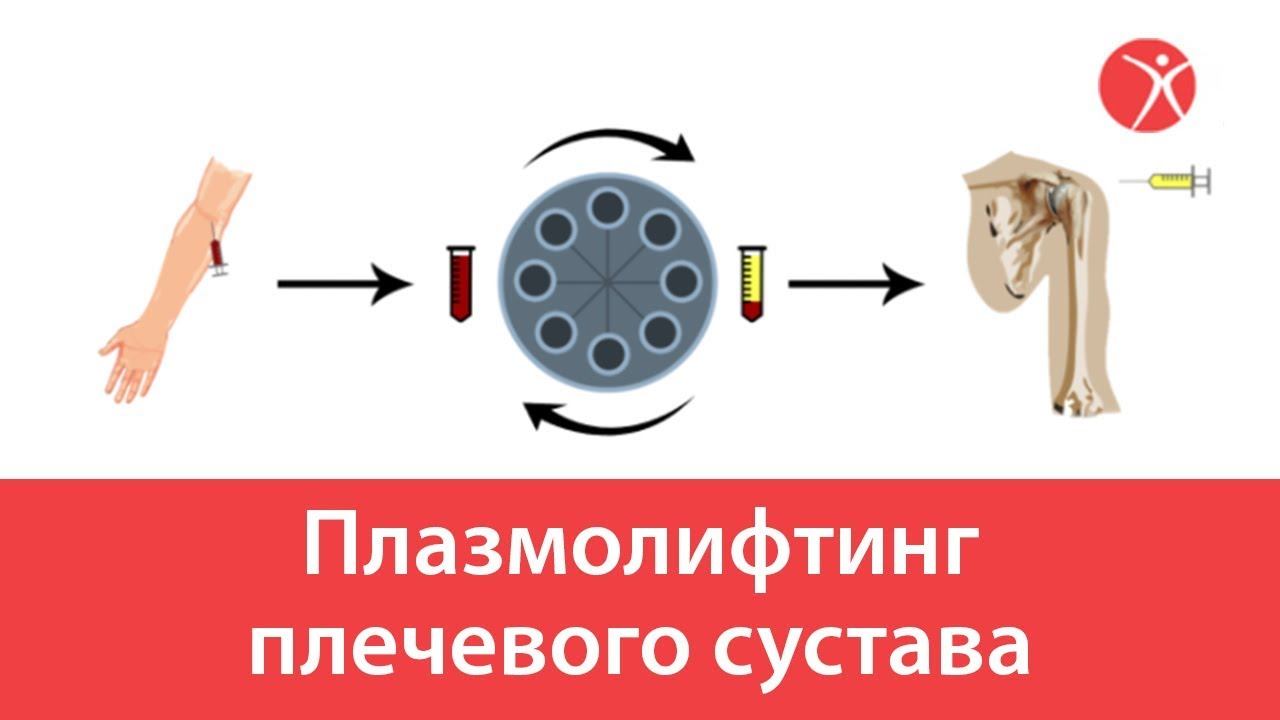 Плазмолифтинг плечевого сустава в клинике Стопартроз