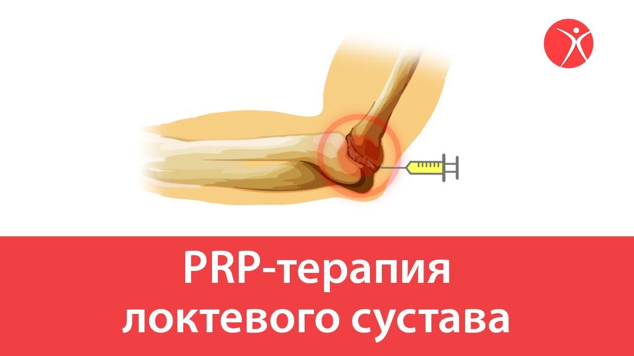 PRP-терапия локтевого сустава