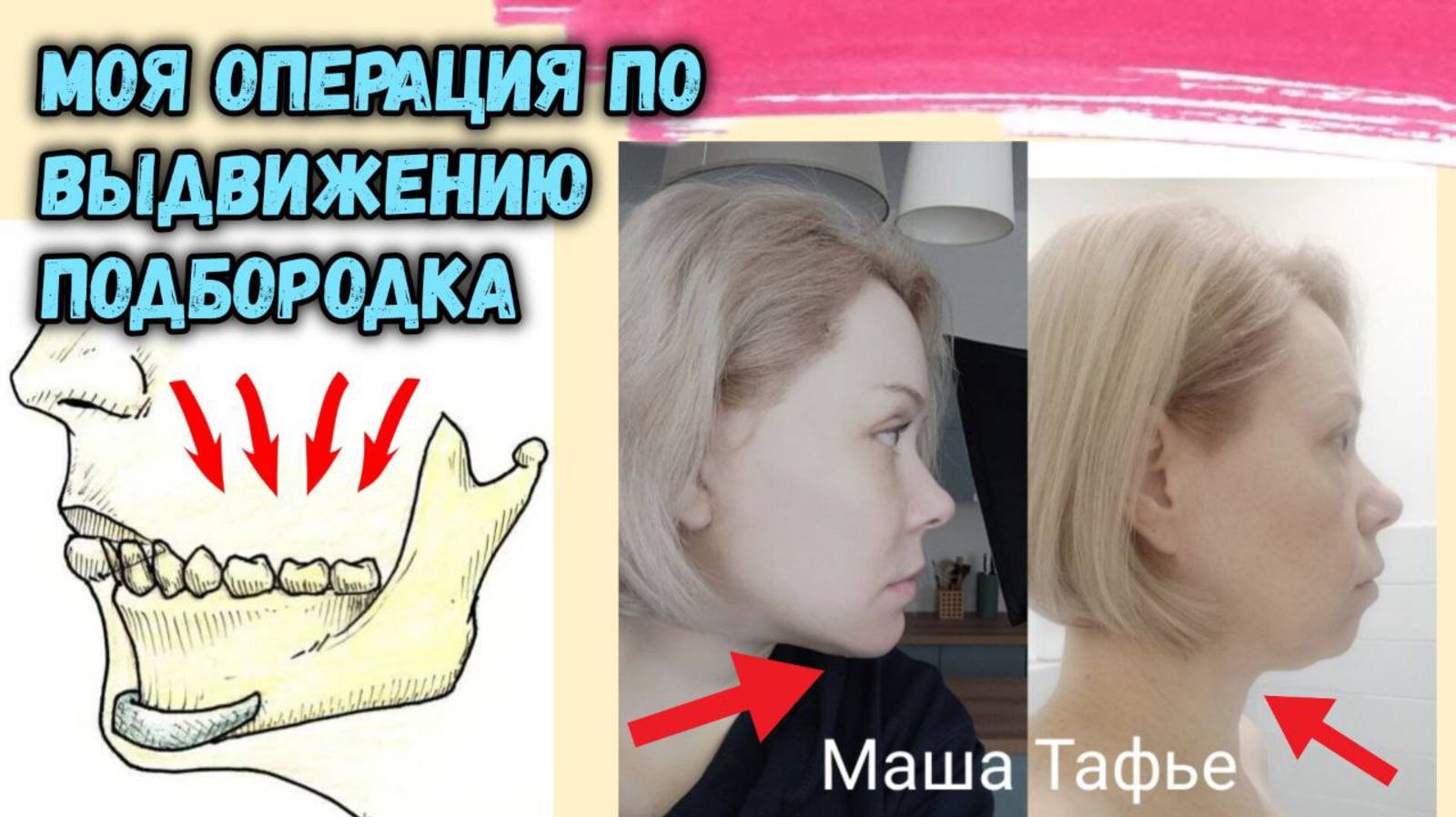 Моя операция по выдвижению подбородка. Весна с Машей 🌷 Видео №53
