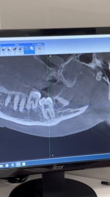 Для чего нужно КТ перед удалением