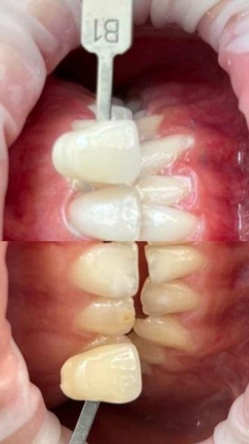 отбеливание зубов Philips Zoom 4