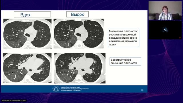 Синдром - понижение плотности легочной ткани и полости