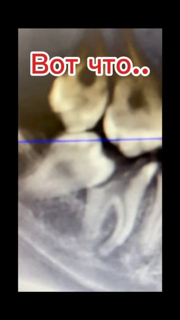 Что будет если не удалить зуб мудрости