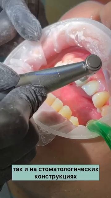 Чистка зубов ультразвуком и реминерализующая терапия