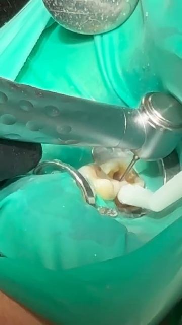 3. Что делать, если у вас периодонтит (киста)