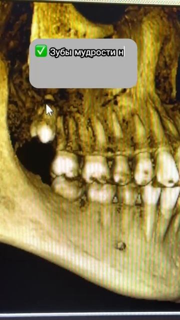 Когда можно сохранить зуб мудрости