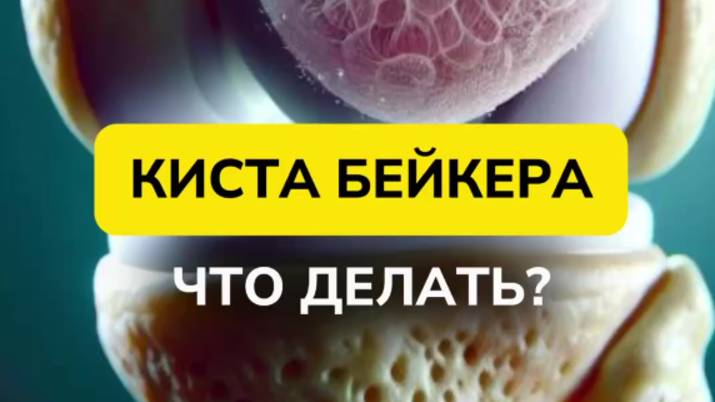 КИСТА БЕЙКЕРА: ЧТО ДЕЛАТЬ?