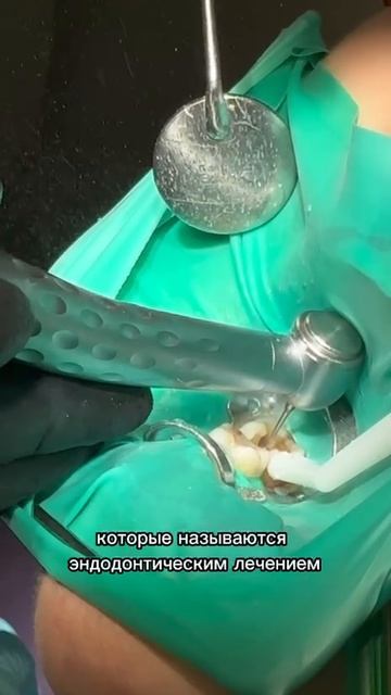 Рентген-контроль при лечении канала 1 ачсть