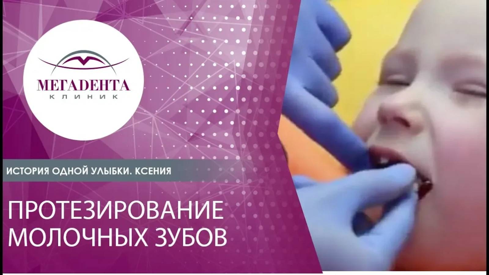 Протезирование молочных зубов. История одной улыбки. Ксения