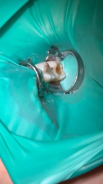 Что такое коффердам