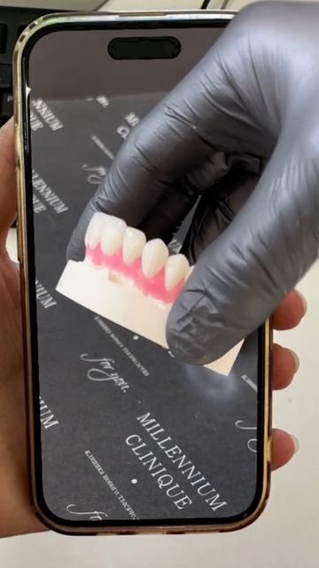 Установка виниров