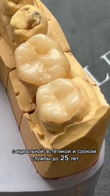 Что такое керамическая накладка на зуб