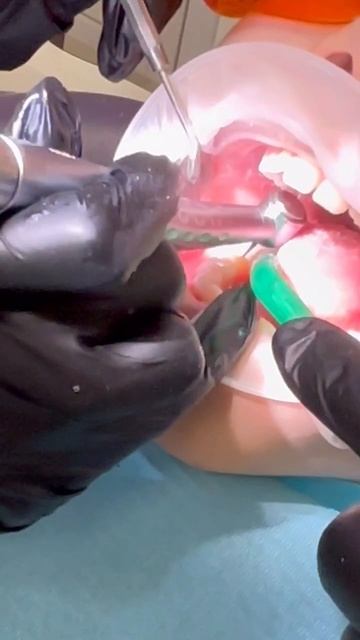 Герметизация фиссур