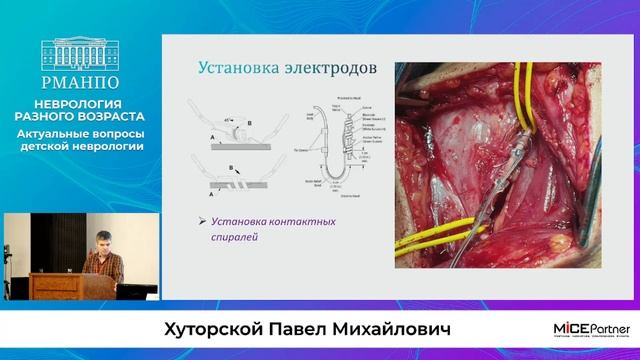 Хуторской П. М. «Опыт применения стимуляторов блуждающего нерва у детей с эпилепсией»