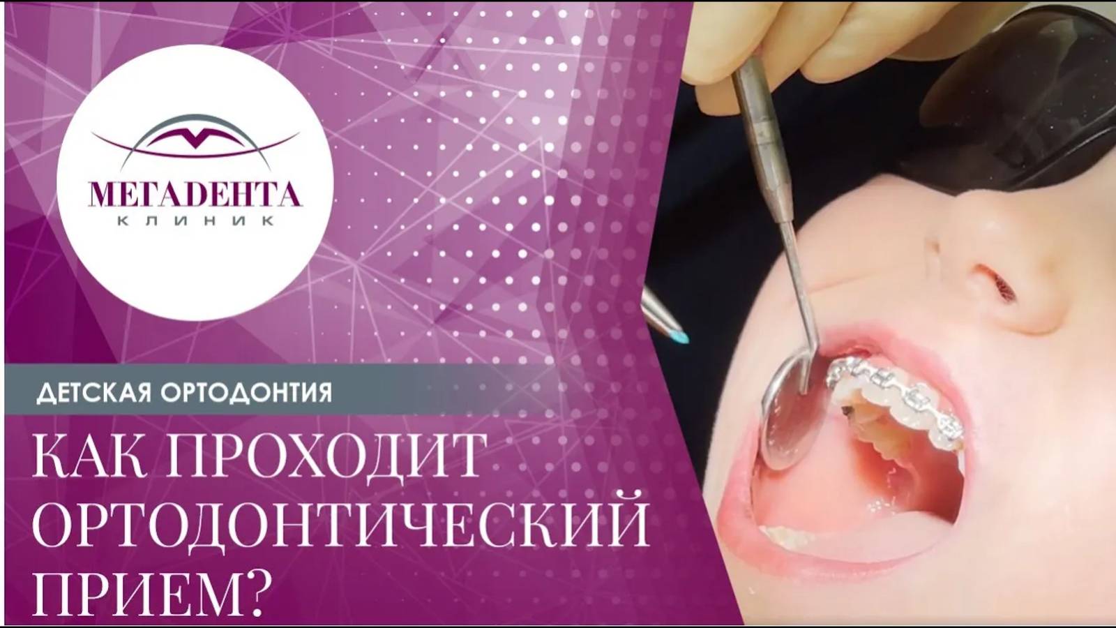 ✅ Исправление прикуса у детей. Как проходит ортодонтический прием?