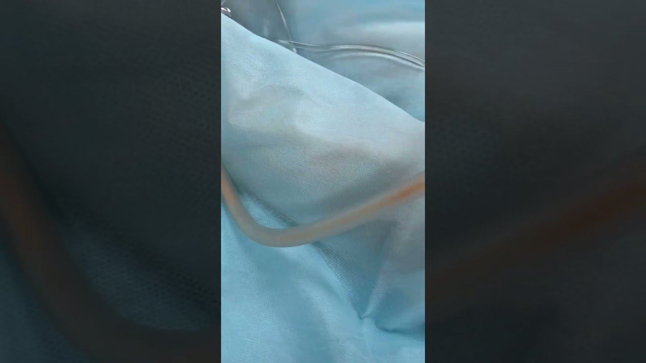 Липосакция при массе тела 44 кг