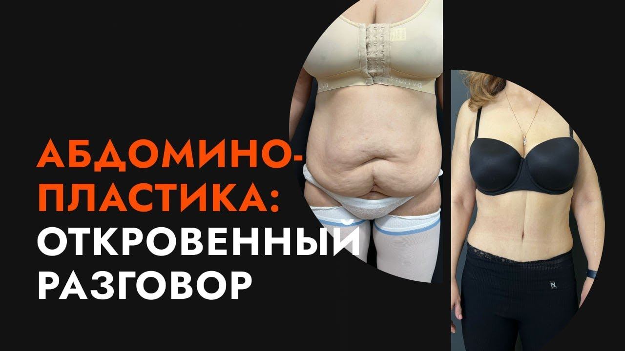 #абдоминопластика: беседа с пациенткой через 1,5 года