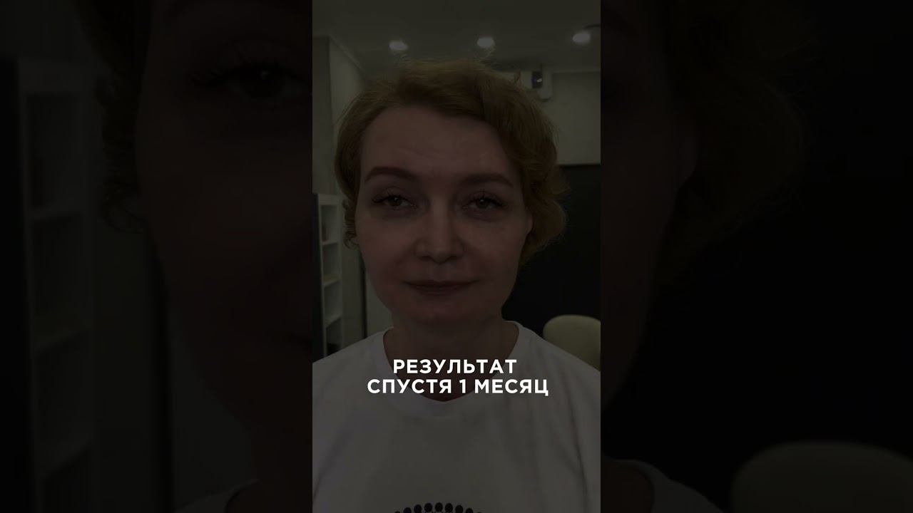 SMAS, #блефаропластика и эндоскопический #лифтинг